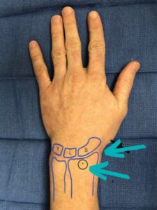 Differential Diagnosis of Radial-Side Wrist Pain - ReHand ...