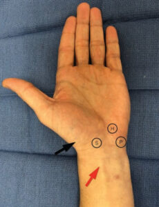 Differential Diagnosis of Ulnar-Side Wrist Pain - ReHand ...