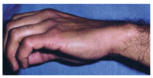 How to diagnose and treat a Palmar Midcarpal Instability