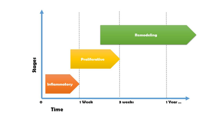 Understanding PIP joint stiffness and its treatment, the Benzema´s ...